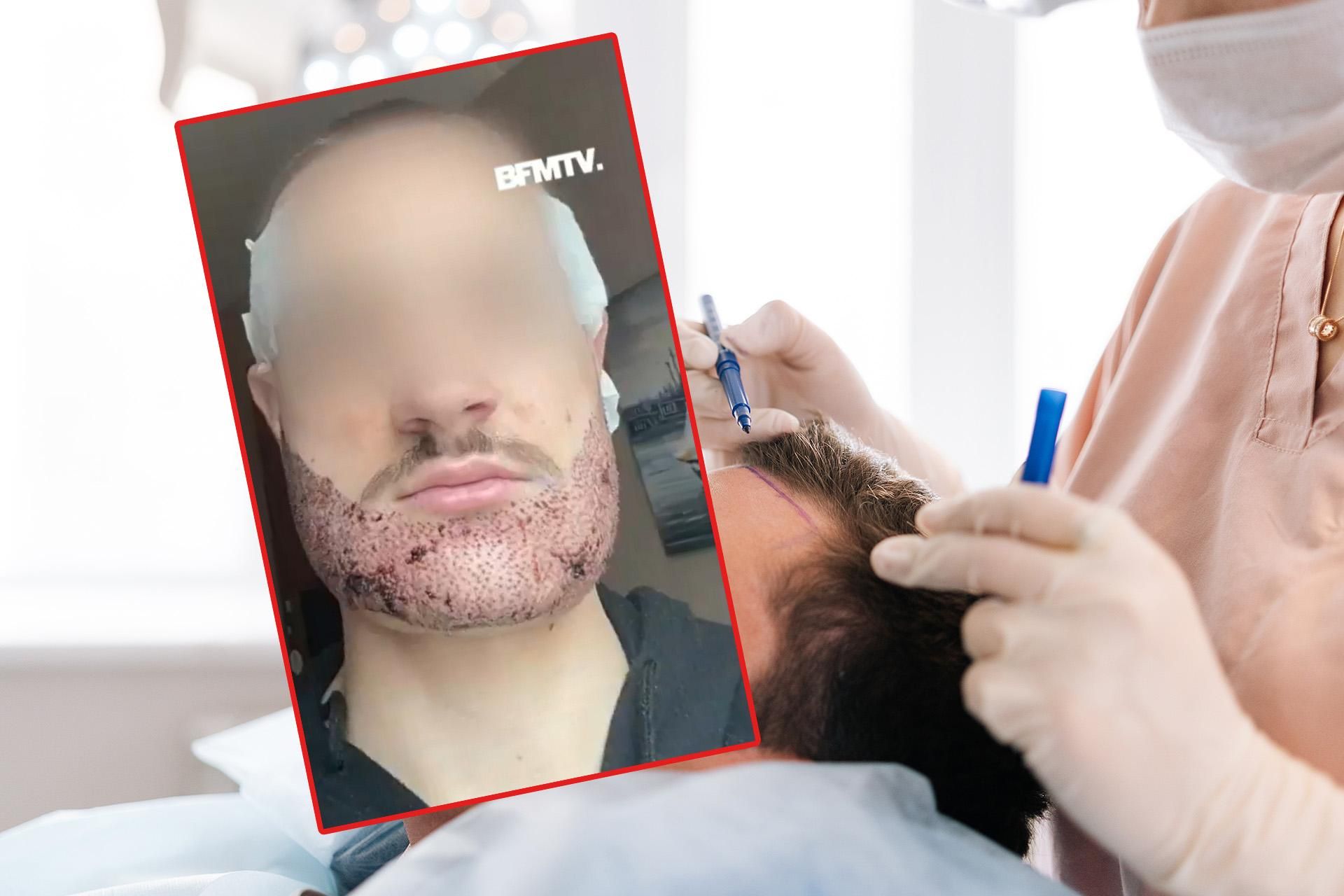 Pojechał do Turcji przeszczepić sobie zarost na brodzie. Teraz nie żyje - Super Express ...