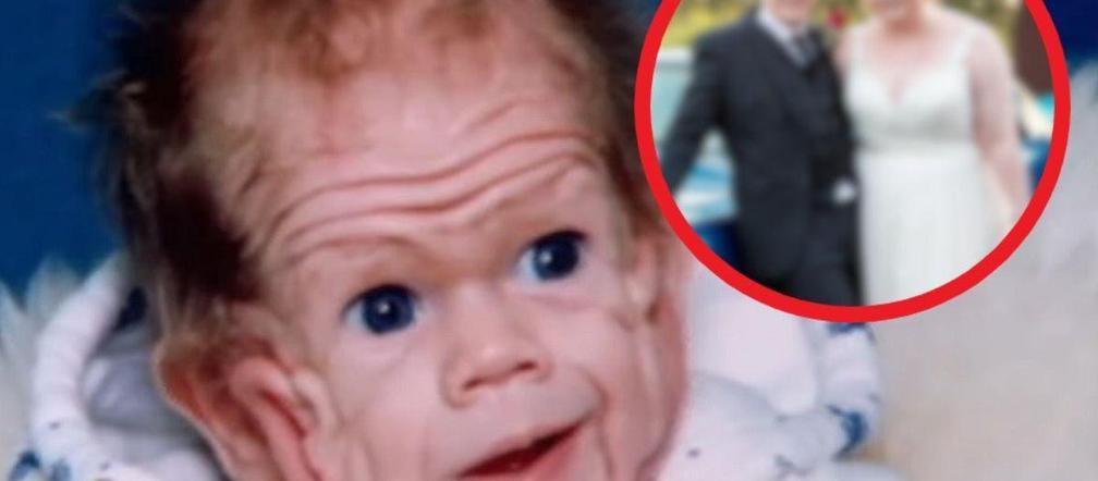 Kiedy się urodził miał tyle skóry, co pięciolatek. Jak dzisiaj wygląda ...