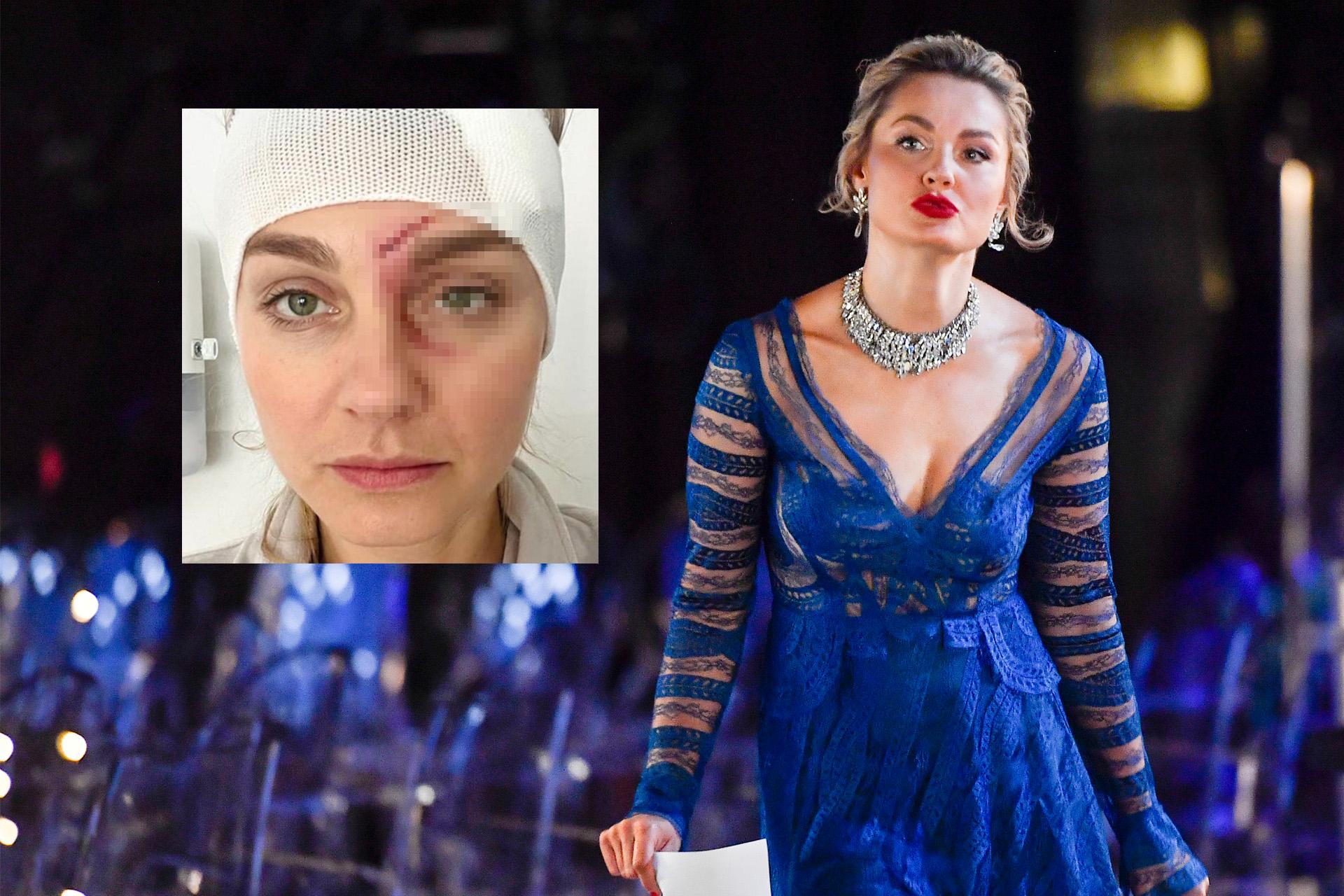 Małgorzata Socha z poranioną twarzą. Można się przerazić! Co jej się ...