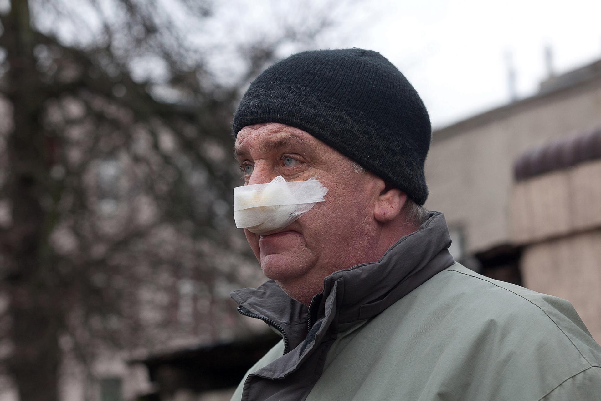 Kanibal ODGRYZŁ mi nos! Dramat pana Ireneusza z Łodzi! - Super Express ...