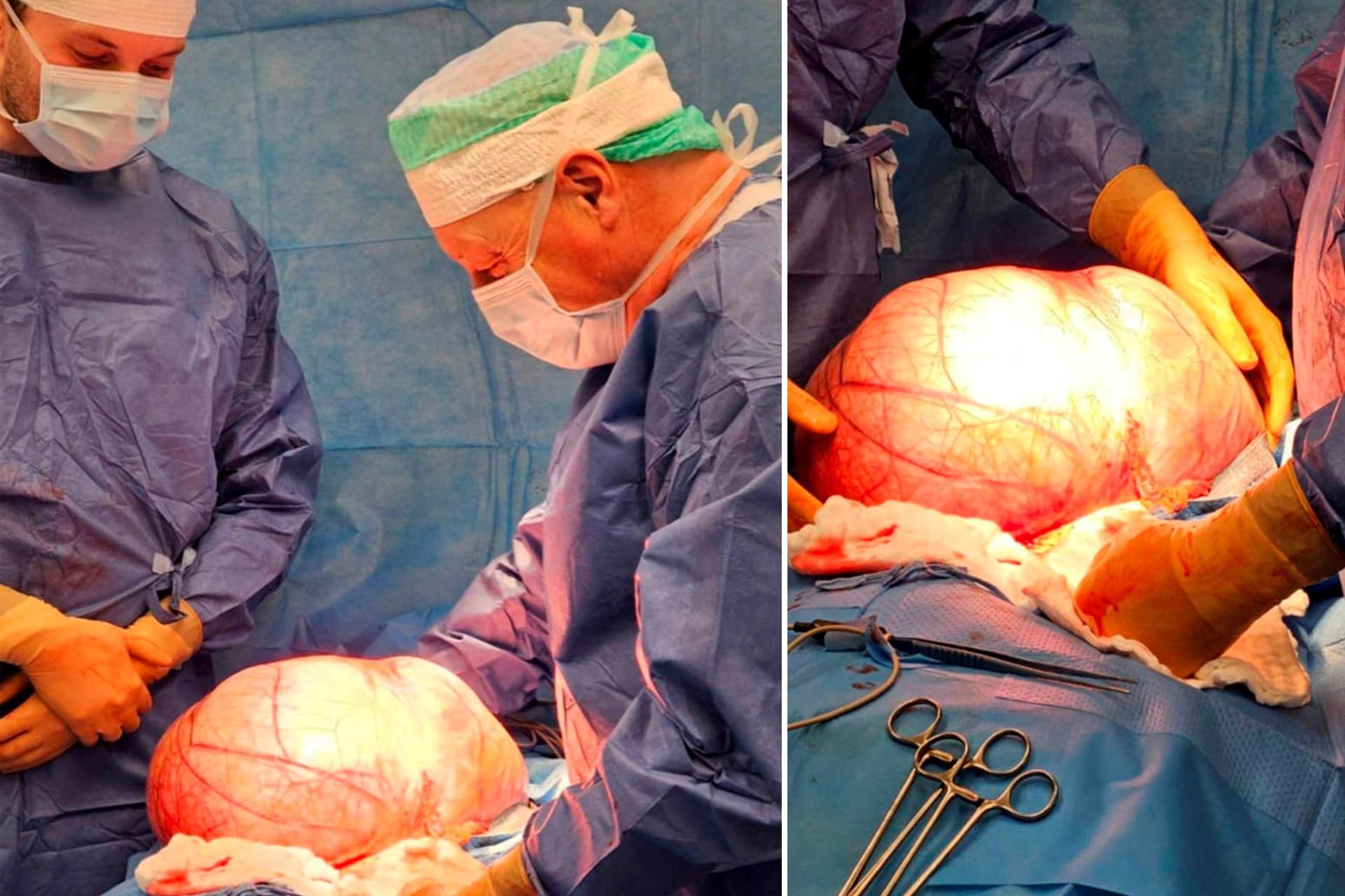 Jasło: Lekarze usunęli 14-kilogramowego guza! Pacjentka żyje dzięki ich ...