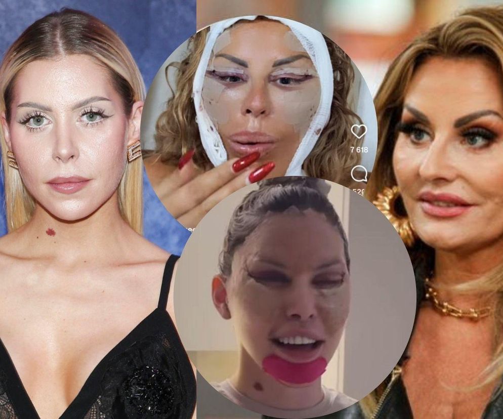 Dagmara Kaźmierska i Julia von Stein po liftingu twarzy. Zobacz metamorfozy gwiazd! - Super ...