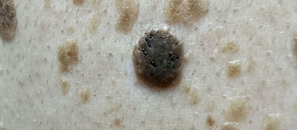 Brodawka łojotokowa czy rak? Dermatolożka apeluje: Nie rozstrzygaj tego ...